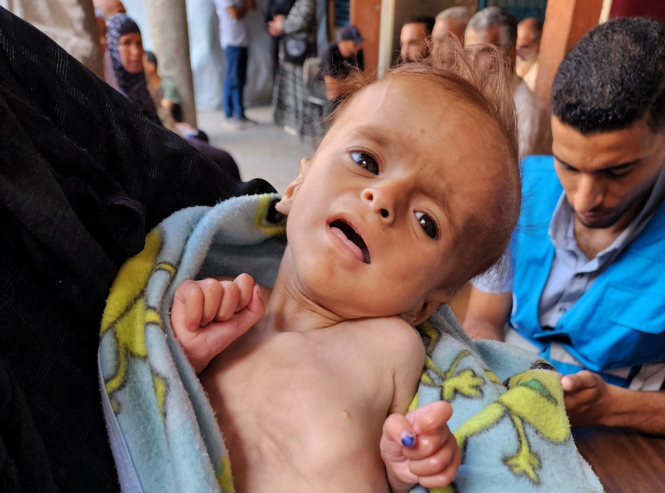 Five deaths, including a child, in Gaza due to famine and malnutrition ...